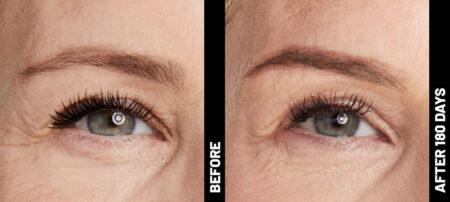 Before And After Gallery | Non-Surgical Ultrasound Lift | Merz Ultherapy