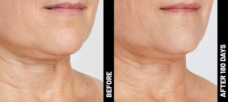Before And After Gallery | Non-Surgical Ultrasound Lift | Merz Ultherapy